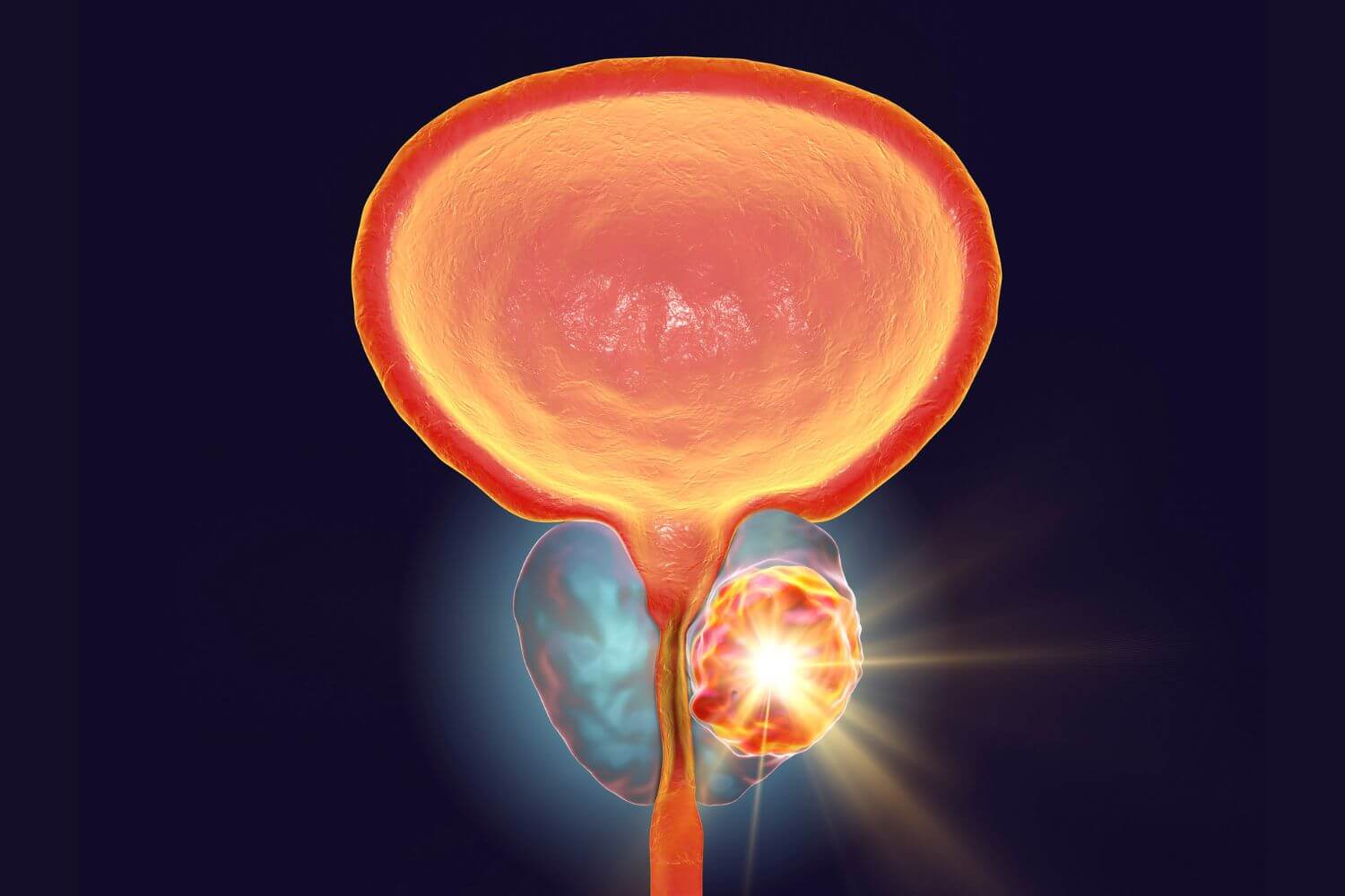 Etapas del cáncer de próstata: qué significan
