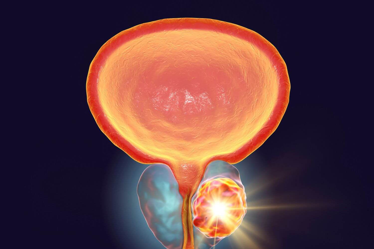 Cirugía robótica para el cáncer de próstata: lo que debes saber